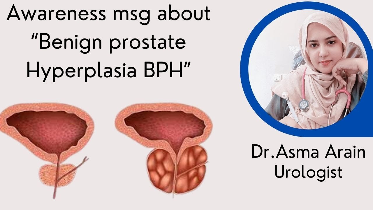 Understanding Benign Prostate Hyperplasia (BPH): Spreading Awareness ...