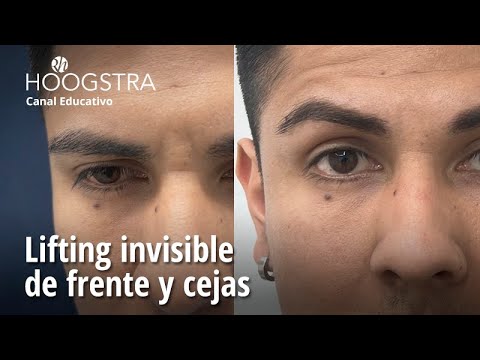 Lifting invisible de frente y cejas - 22314 - YouTube