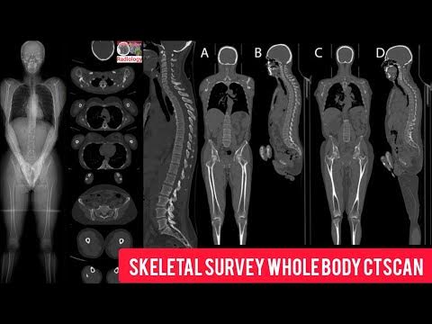 Whole Body Ct Scan | Skeletal Survey CtScan | #wholebody # ...