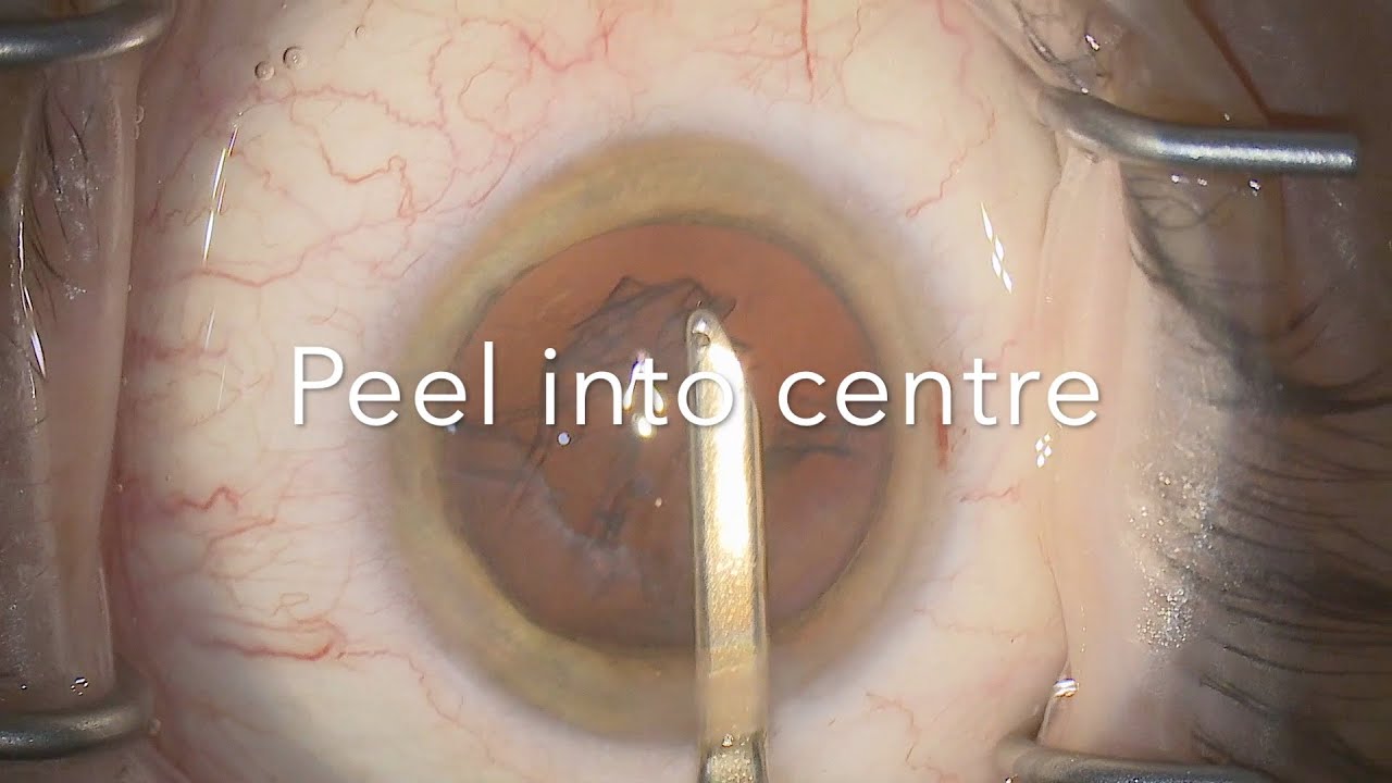Deconstructing Cataract Surgery 5 - Cortex clean up - YouTube