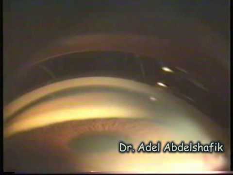 Ophthalmolgy- Test yourself: gonioscopy 01 - YouTube