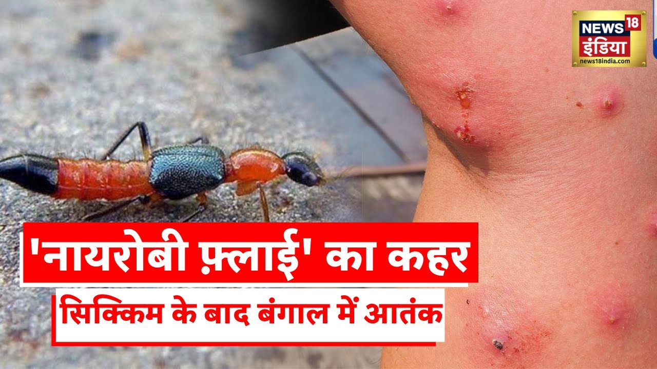 Acid Fly News: कीड़े के काटने से फैलता है ज़हर, Siliguri में 100 लोग ...