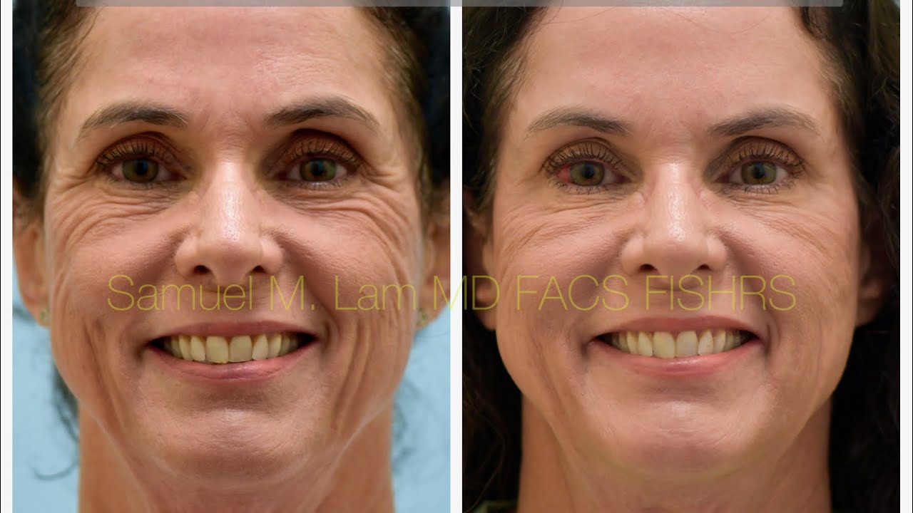 Dynamic Filler, MesoBotox Testimonial - YouTube