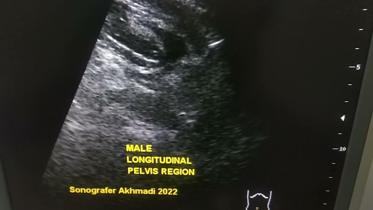 Teknik Pengukuran USG Prostat (Transabdominal) - Prostat Ultrasound ...