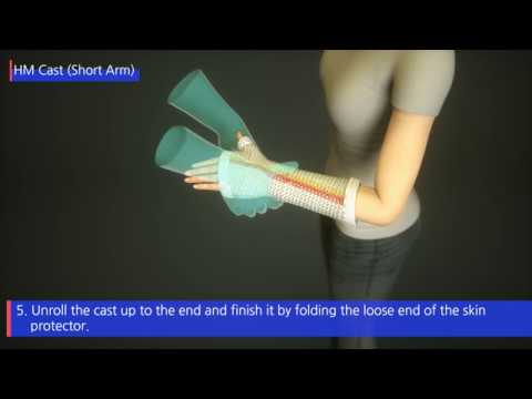 HM CAST Short Arm (3D Procedure) - YouTube