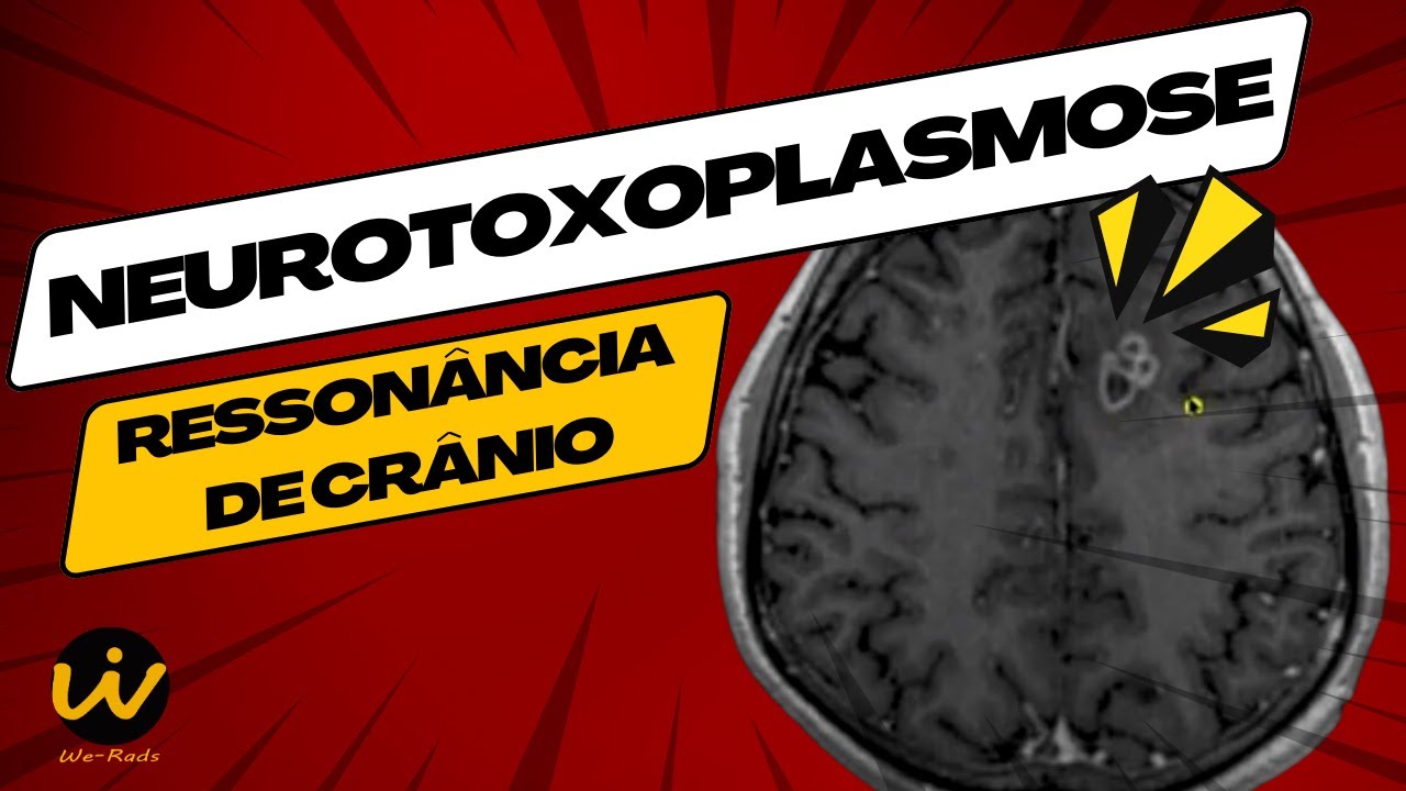 NEUROTOXOPLASMOSE na Ressonância Magnética de CRÂNIO em HIV/AIDS - YouTube