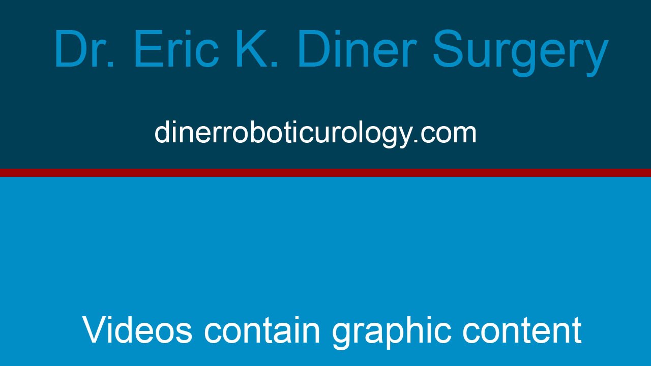 Robotic Left Nephroureterectomy - YouTube