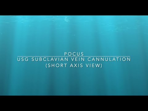 USG guided subclavian CVP line insertion (short axis view)|Ultrasound ...