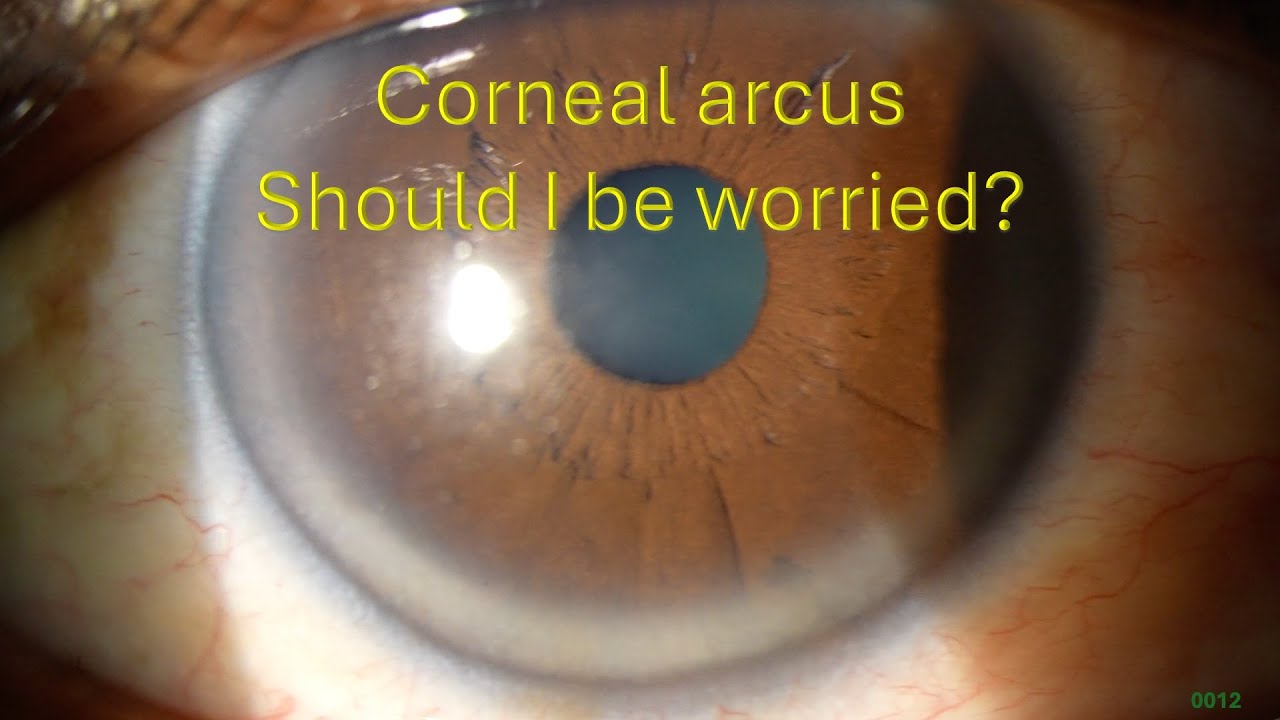 0012: Corneal Arcus - Should I be worried? - YouTube