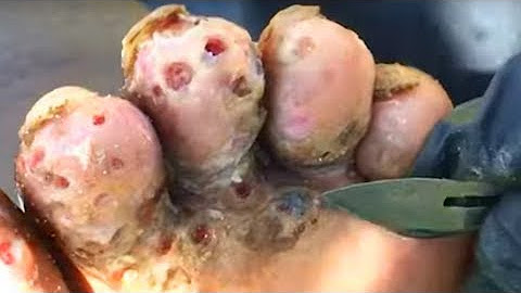 Jigger Removal - YouTube