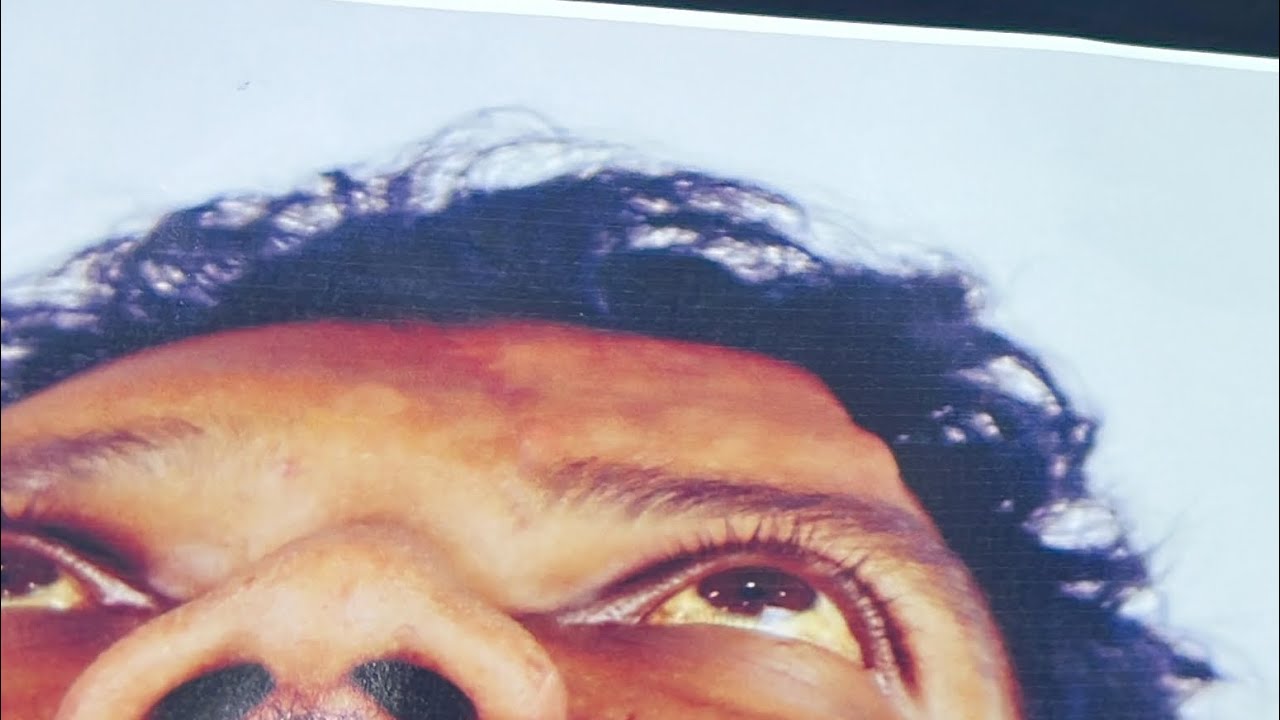 Best Forehead Surgery in India - Dr Sunil Richardson - YouTube