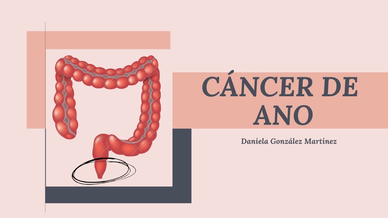 Oncocápsulas de la salud: CÁNCER DE ANO - YouTube