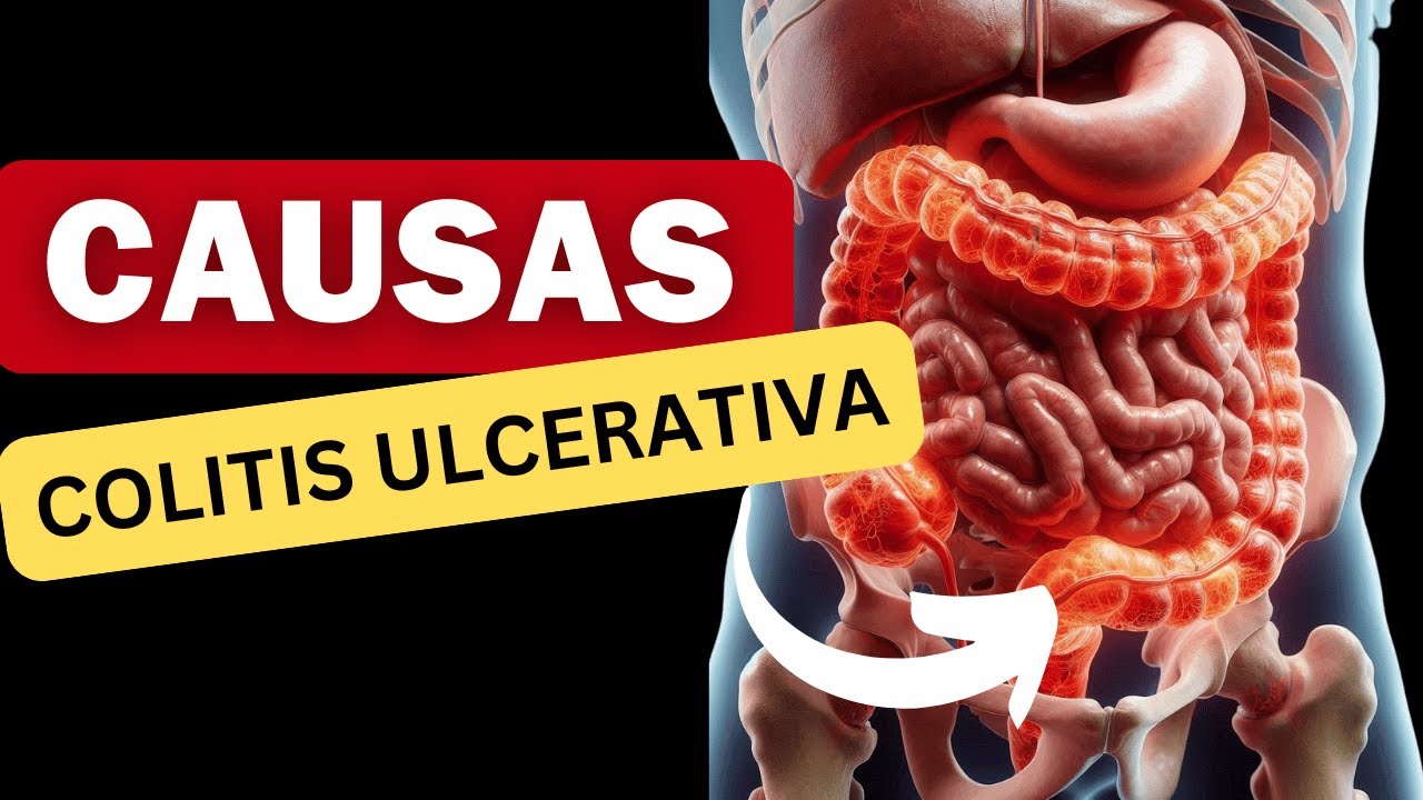 CAUSAS DE COLITIS ULCERATIVA [ Actualizado 2024 ] - YouTube