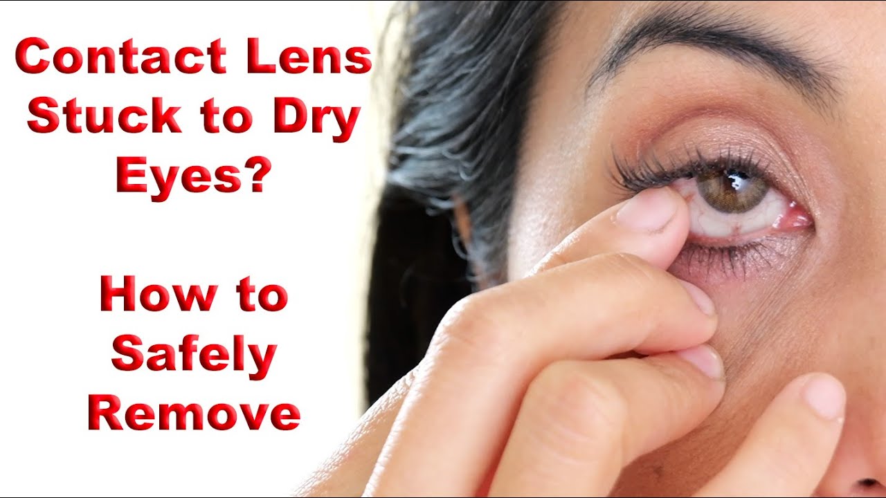How to Safely Remove Stuck Contact Lens Dried to the Eye - YouTube