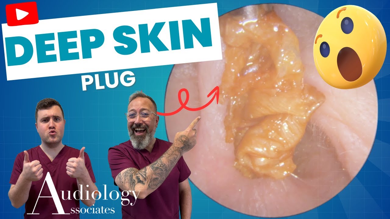 Deep Skin Plug Removed from Ear! 😳 You Won't Believe How It Came Out ...