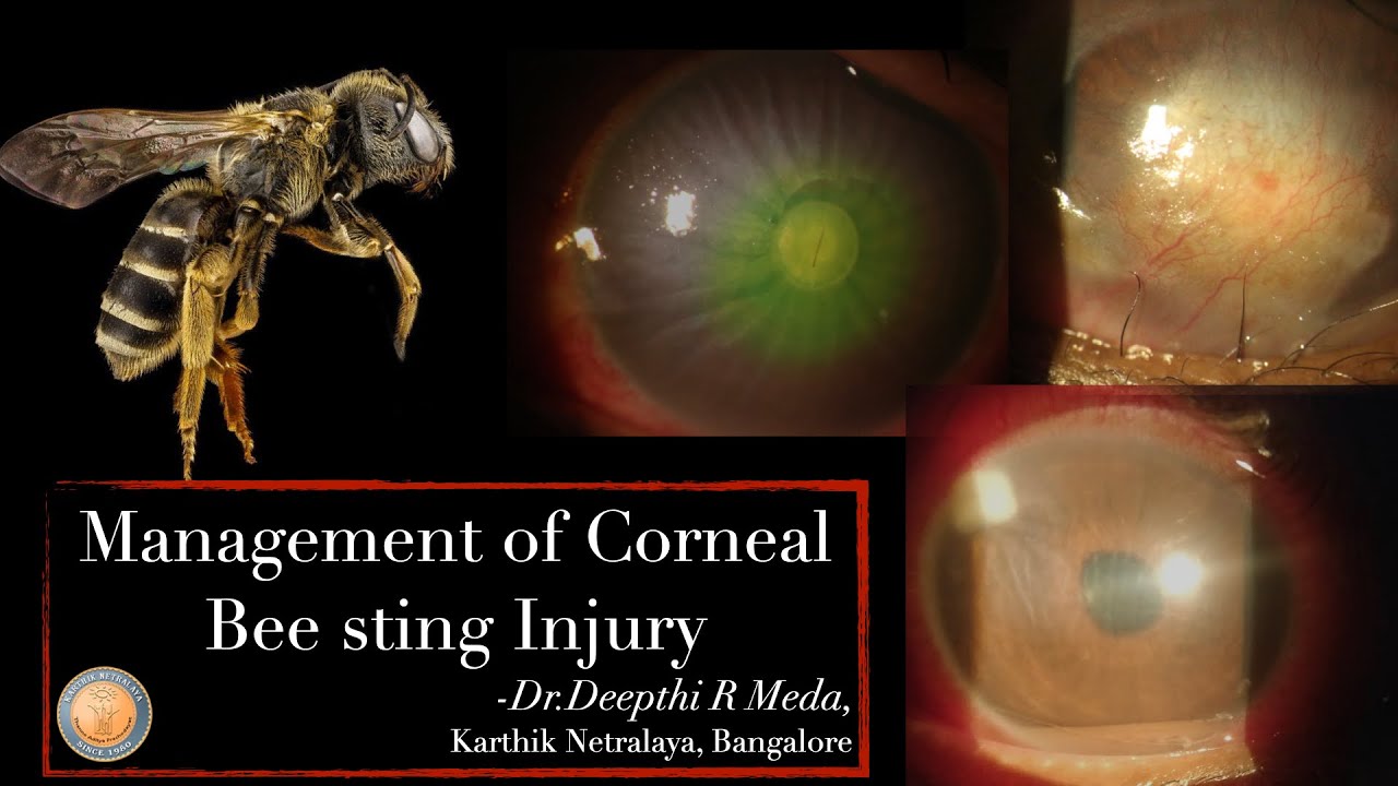Management of Corneal Bee sting injury. -Dr.Deepthi R Meda. - YouTube