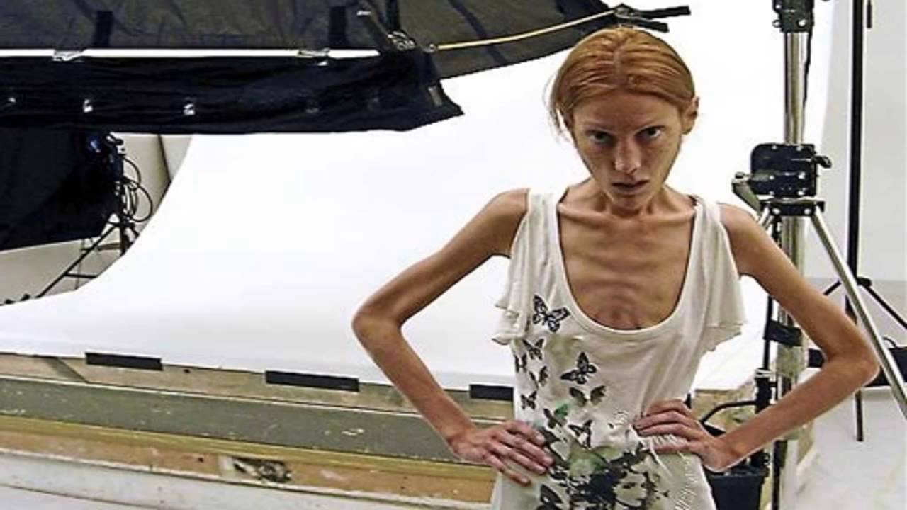Anorexia Actividad semana 3 - YouTube Anorexia Actividad semana 3 - YouTube