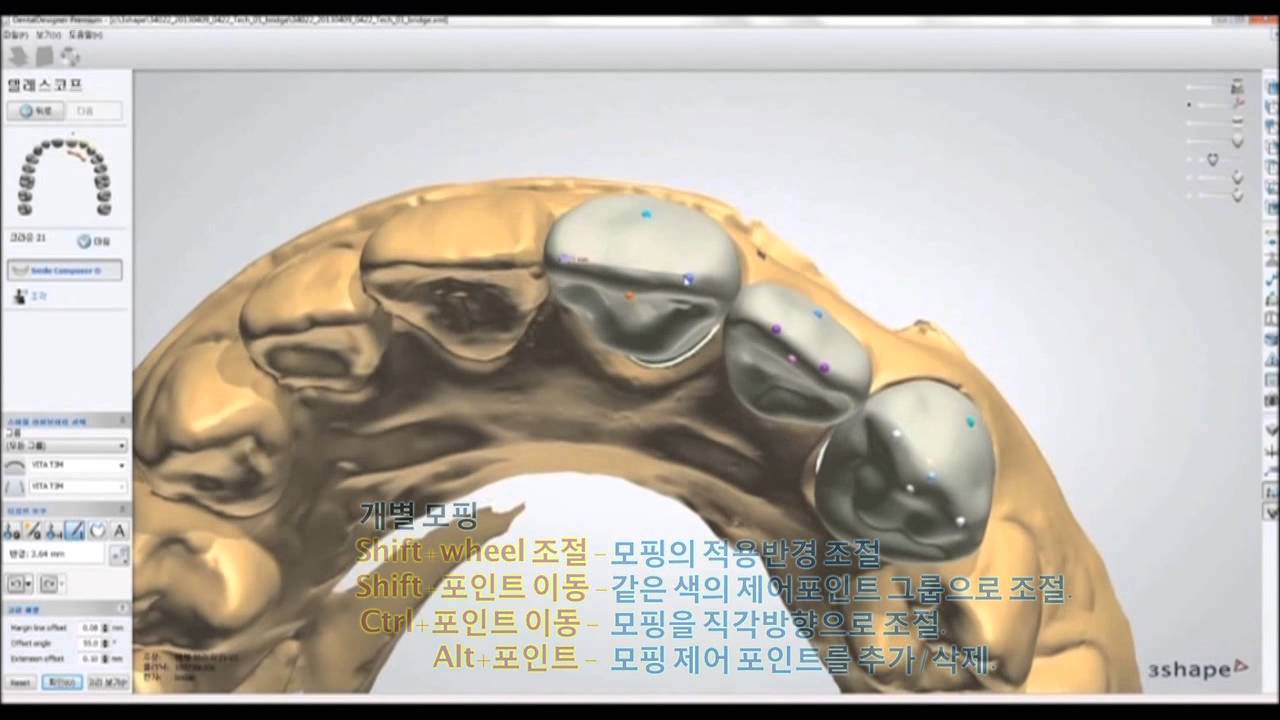 2-3shape dental system(Bridge) - YouTube