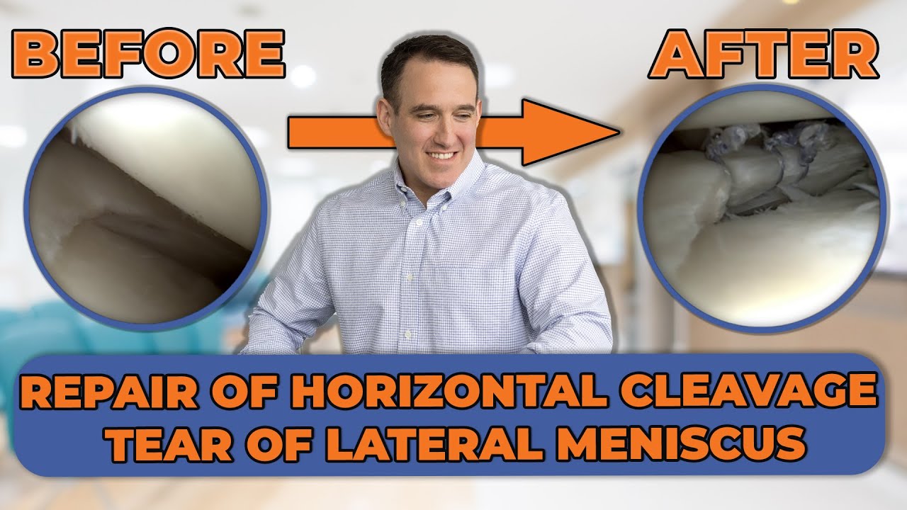 Repair Of Horizontal Cleavage Tear Of Lateral Meniscus - YouTube