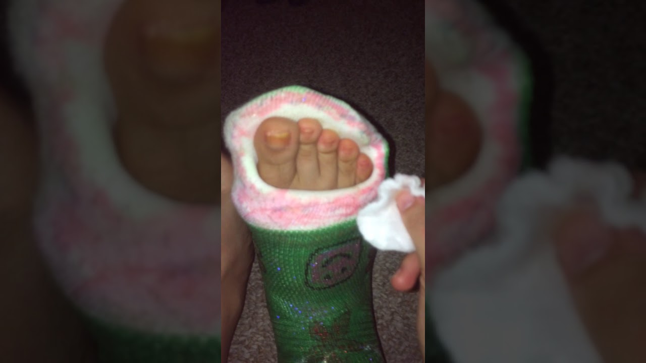 How I remove nail polish in a leg cast - YouTube