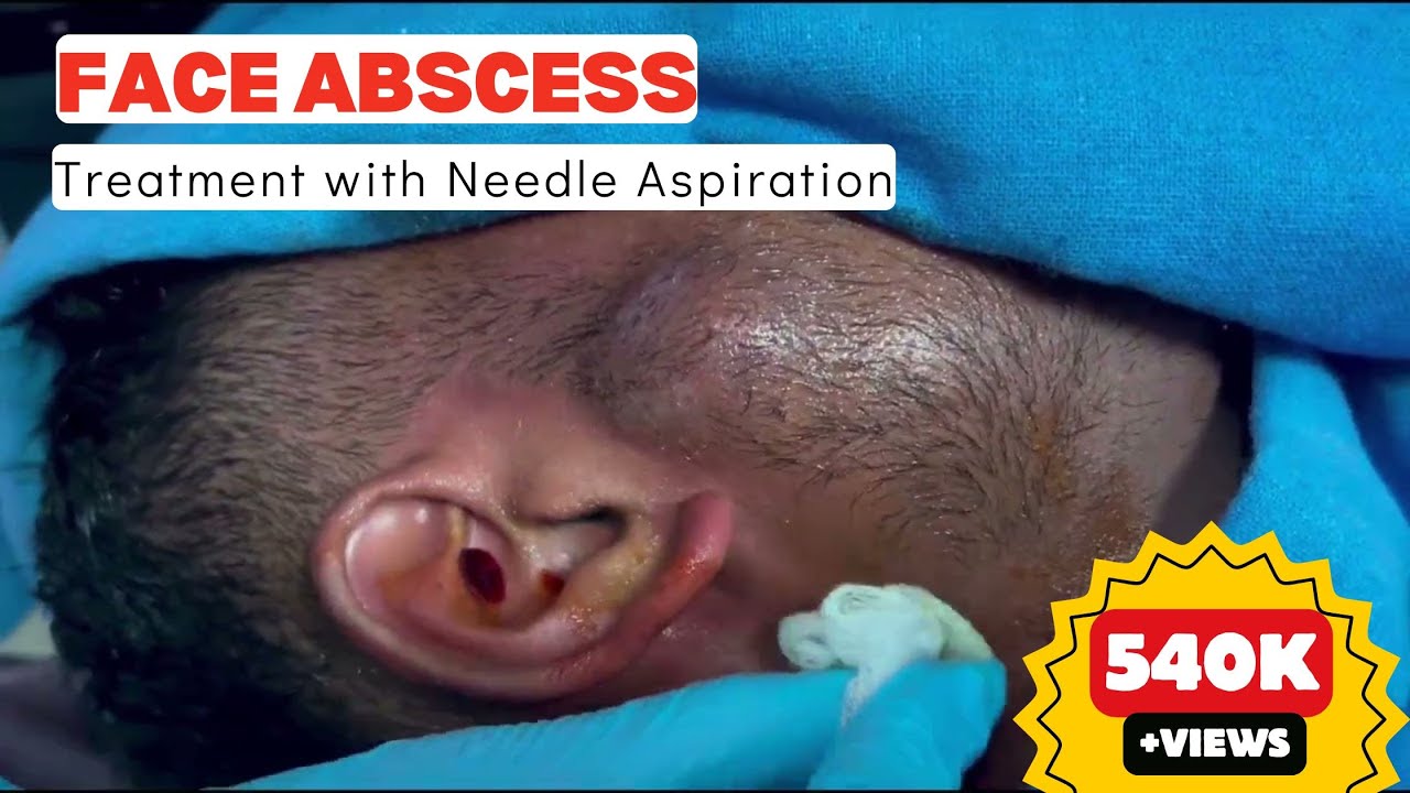 FACE ABSCESS || An immediate improvement after pus aspiration || Needle ...