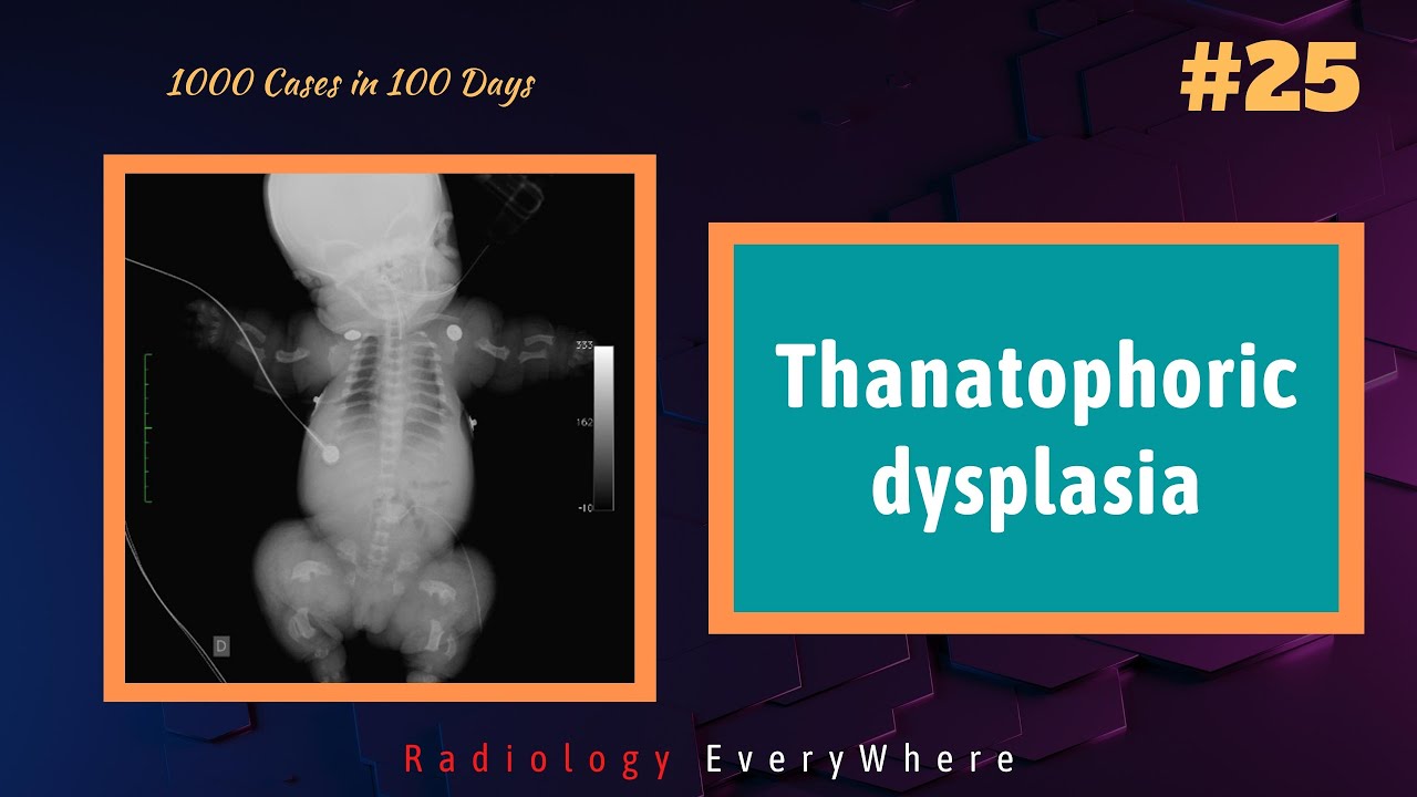 Thanatophoric Dysplasia | Radiology Tutorials | 1000 cases in 100 days ...