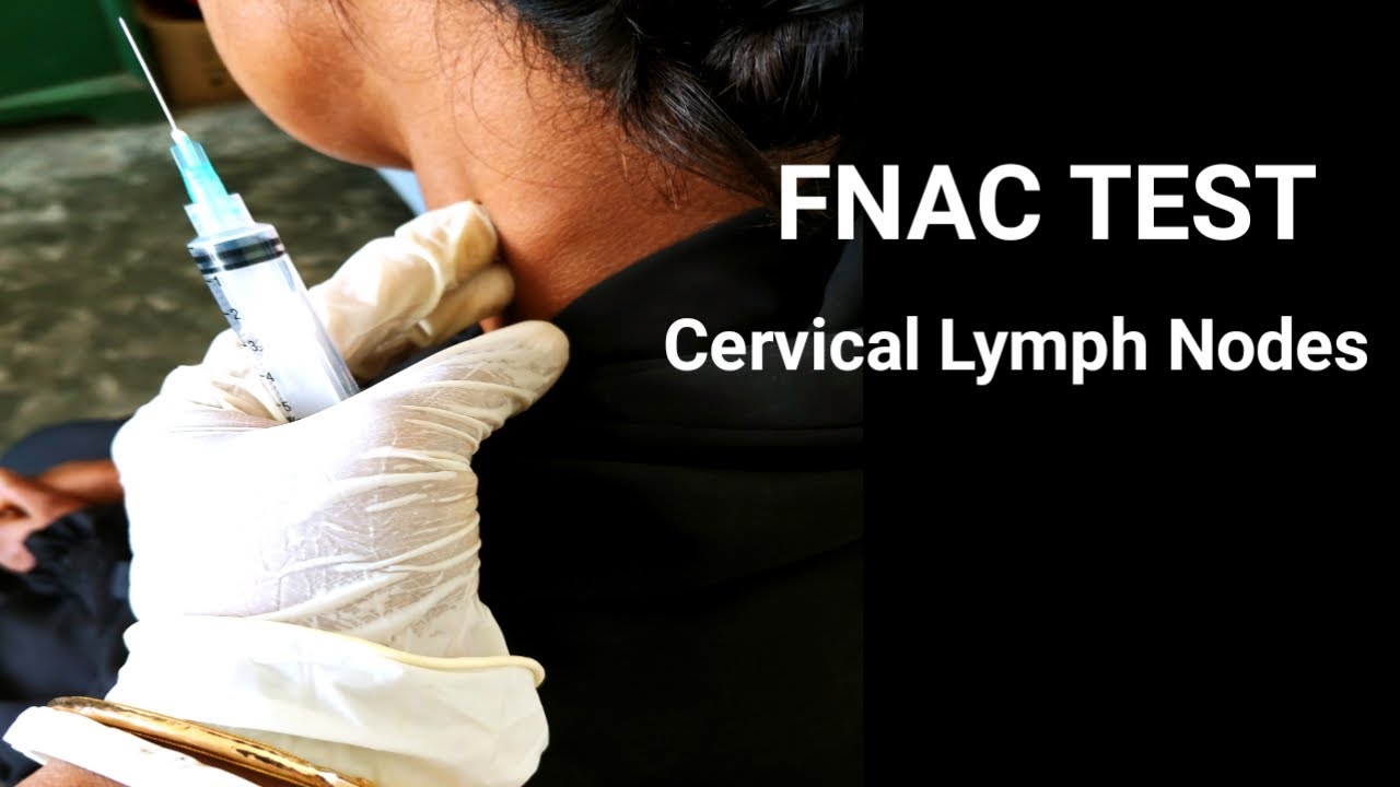 FNAC For Cervical Lymph Nodes।। - YouTube