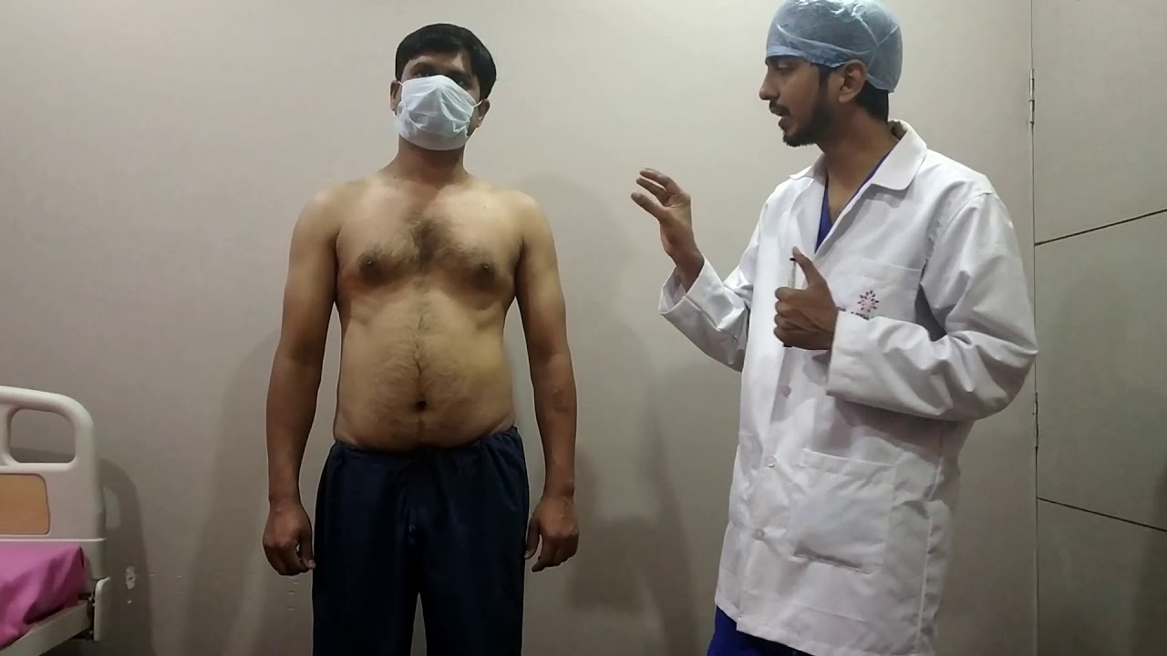 Everything you want to know about Grade 2 Gynecomastia explained by ...