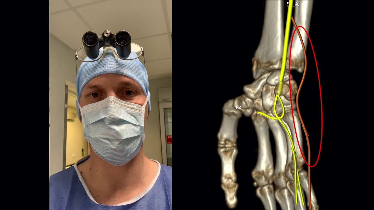 Un traumatisme du nerf ulnaire... - YouTube