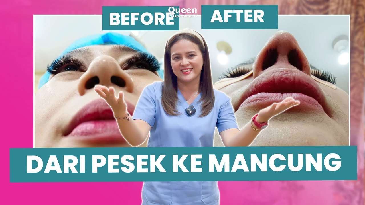 DARI PESEK HINGGA MANCUNG PERMANEN, RHINOPLASTY DI QUEEN PLASTIC ...