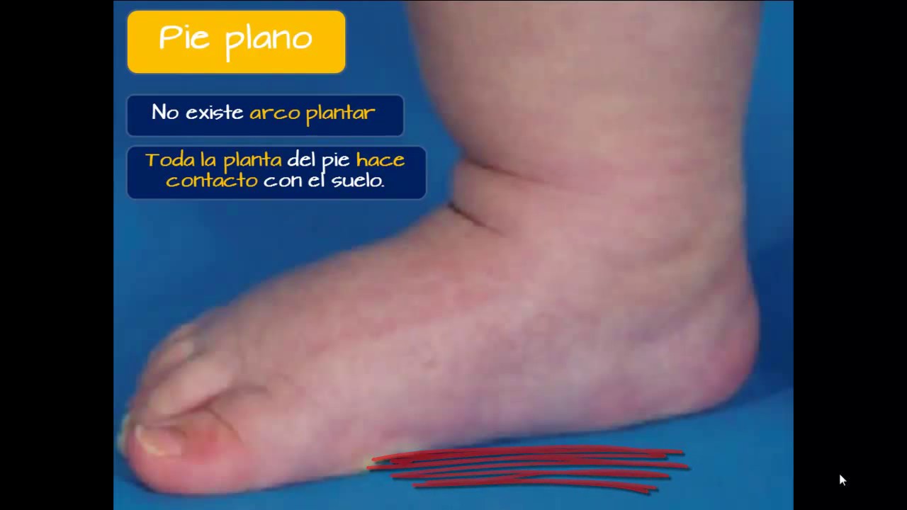 Deformidades en las extremidades más frecuentes en los niños - YouTube
