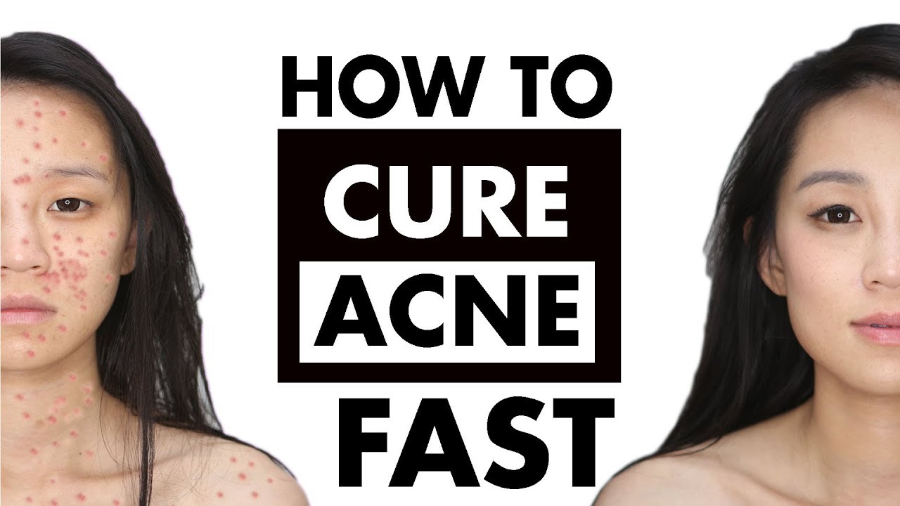 How To Get Rid of Acne | Best Spot Treatment | How To Use Benzoyl ...