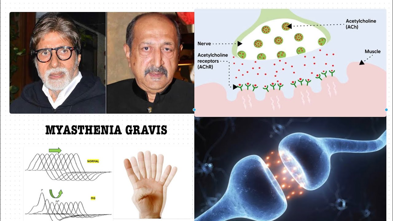 Myasthenia gravis and Lambert Eaton syndrome | HAND WRITTEN NOTES ...