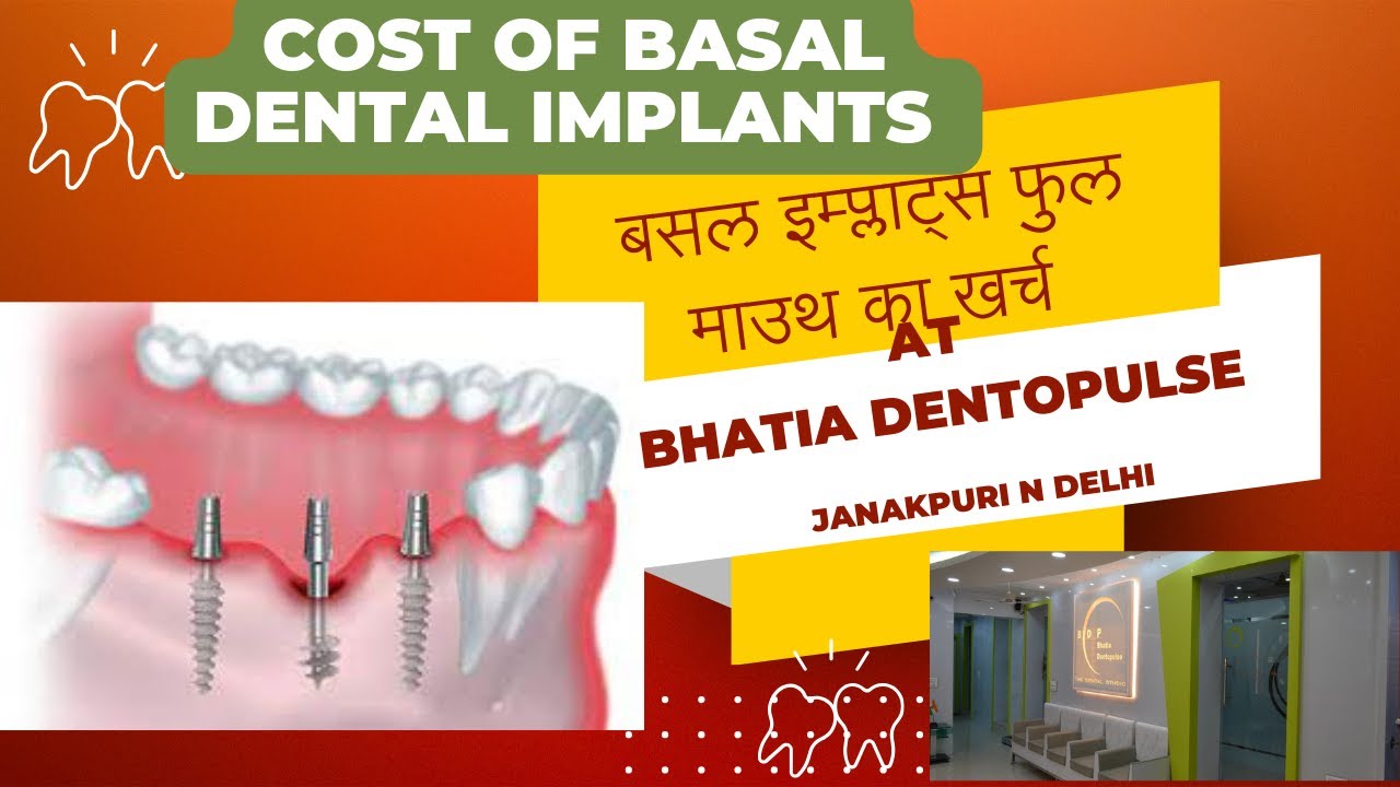 बसल इम्प्लांट्स फुल माउथ का खर्च ,COST OF BASAL IMPLANTS COST-FULL ...