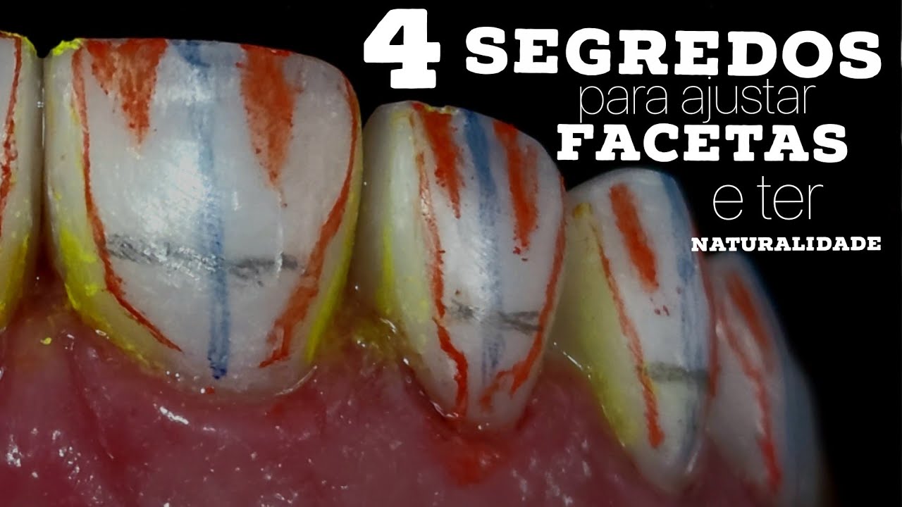 🛑4 SEGREDOS PARA FACETAS SUPER NATURAIS!PASSO A PASSO PARA IDENTIFICAR ...