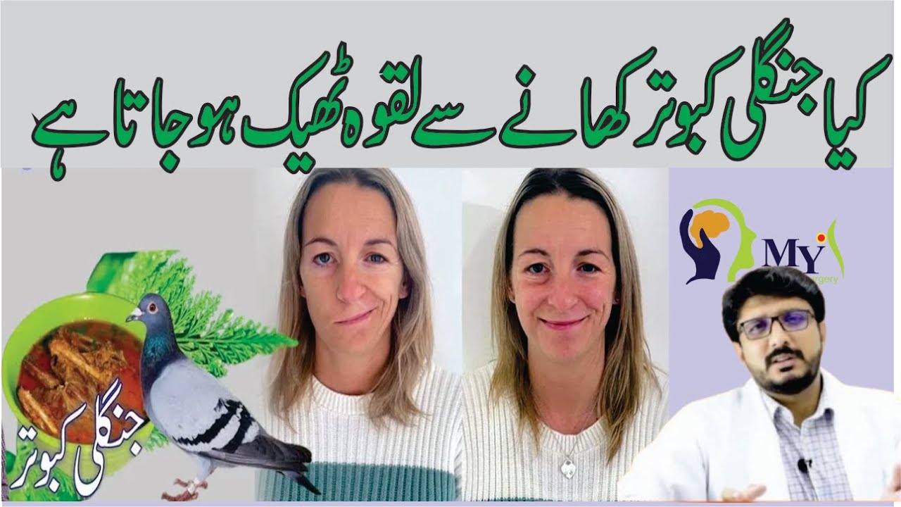 Laqwa ka Ilaj | How to Treat Bells Palsy by dr mohsin || facial palsy ...