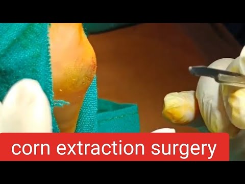 corn extraction surgery | corn callus removal surgery | #doctor # ...