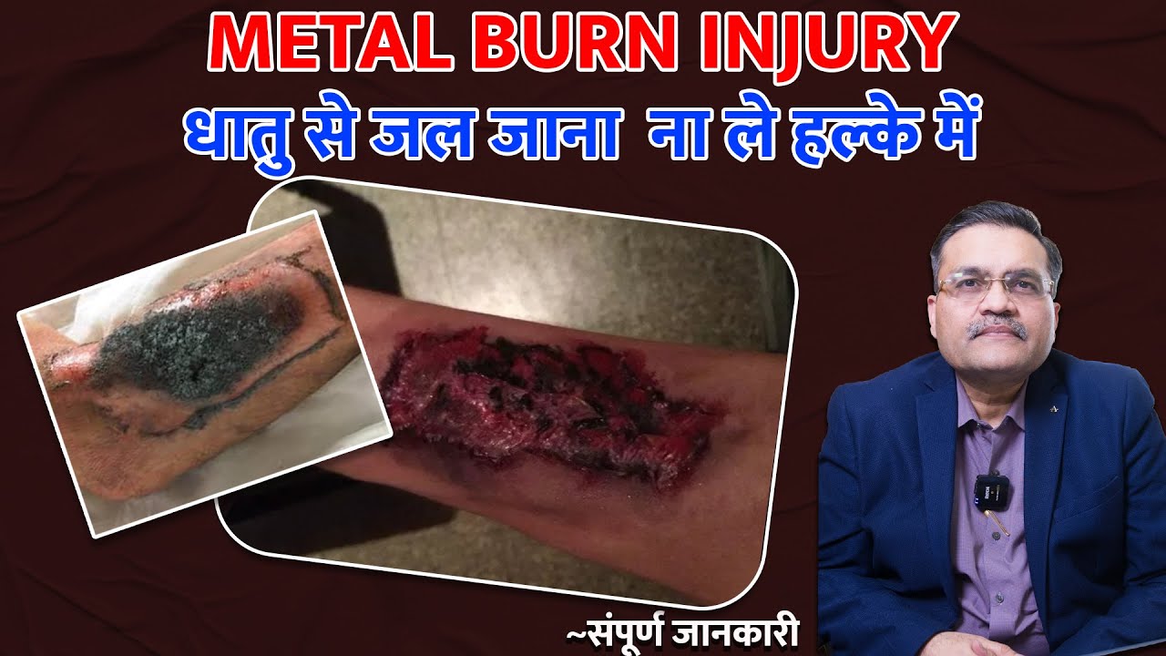 Metal Burn Injury | किसी भी गरम धातु से जल जाने से होता है थर्ड डिग्री ...