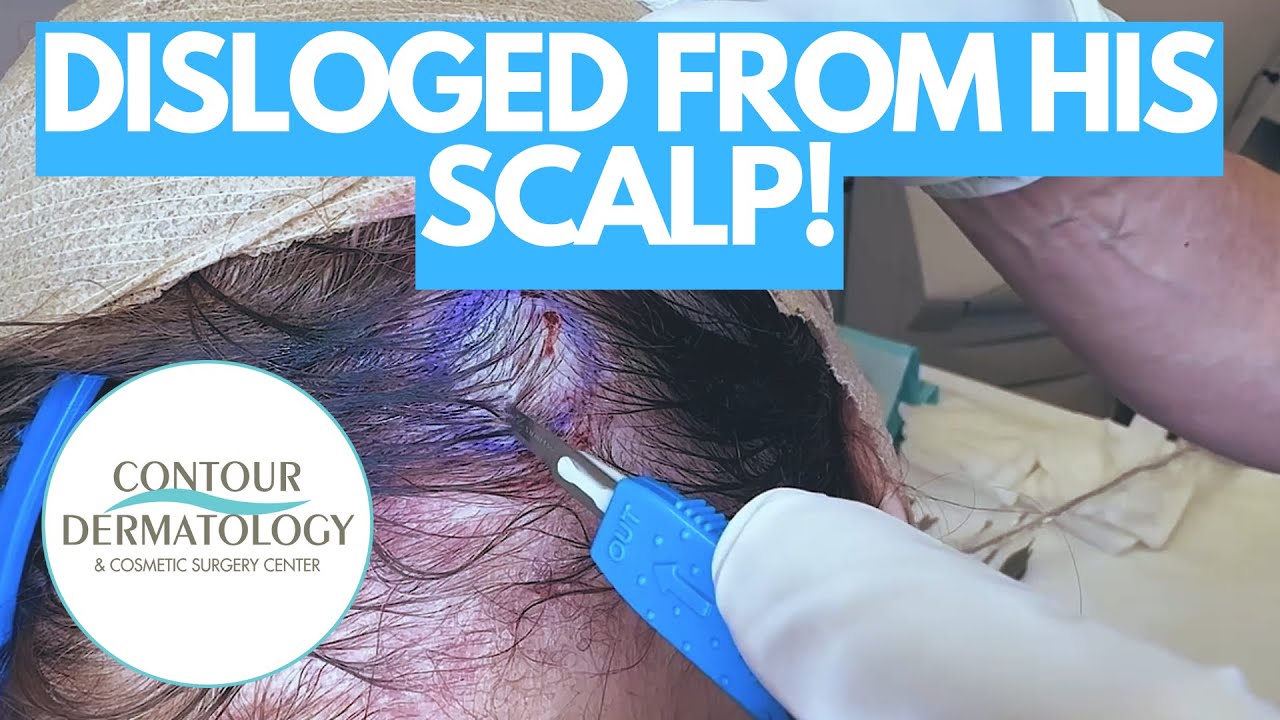 Excavating a Crater Cyst from the Scalp | CONTOUR DERMATOLOGY - YouTube
