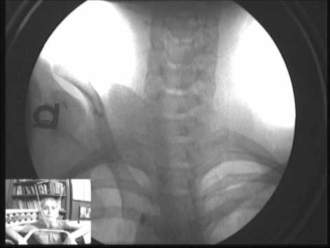 MY SPINE! A Digital Motion X-Ray of a Scoliosified Spine - YouTube