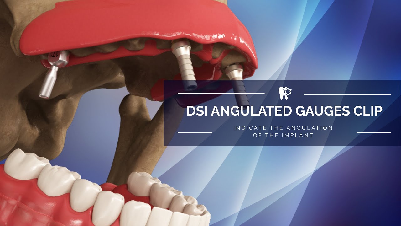 Implant Angulation Indication Gauge Clip - YouTube