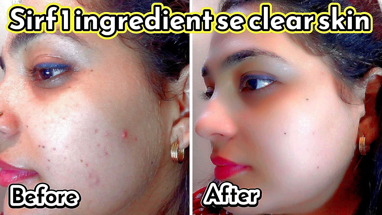 How Mandelic Acid Faded My Dark Spots and Hyperpigmentation! |Indian ...