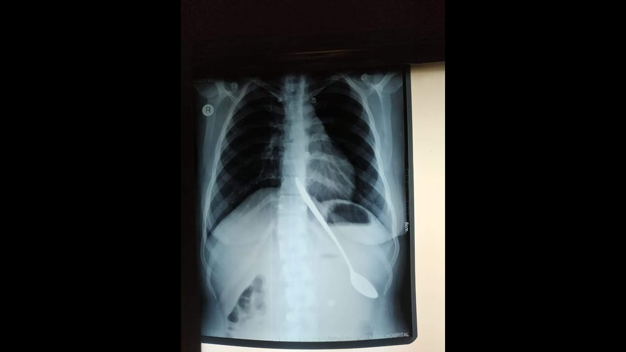 Laparoscopic spoon and intragastric balloon extraction - YouTube