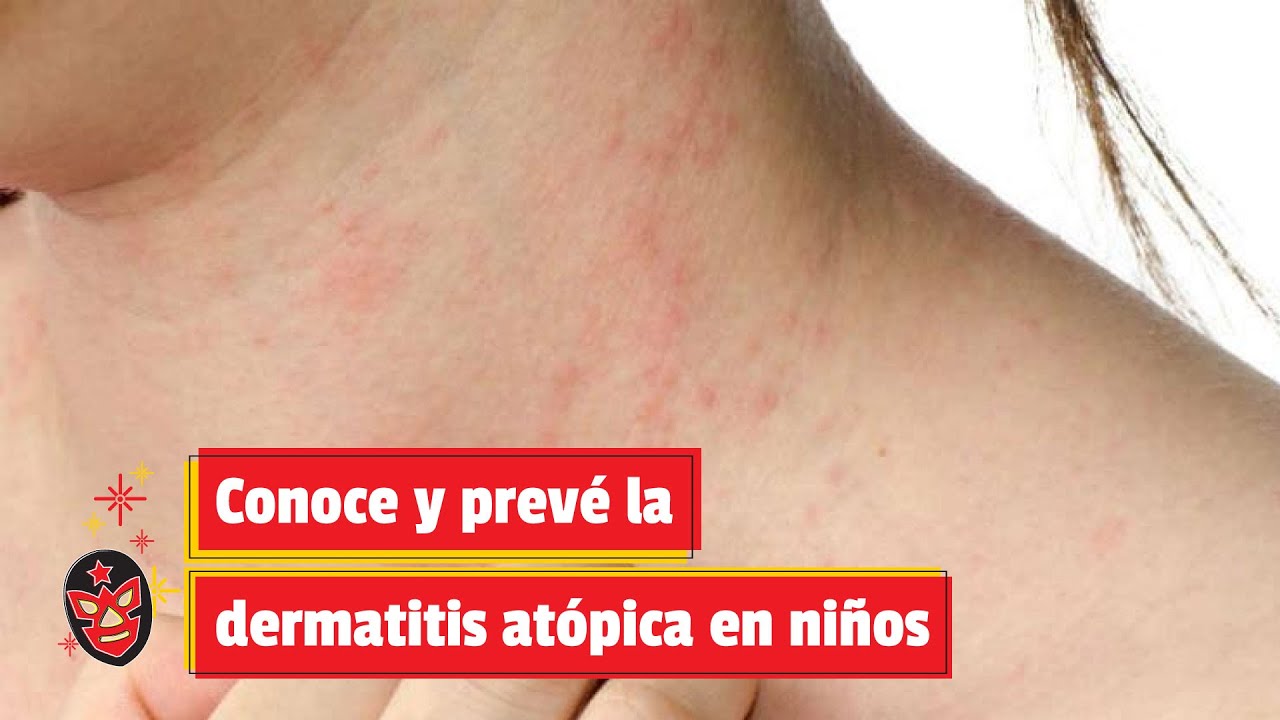 Conoce y prevé la dermatitis atópica en niños - YouTube