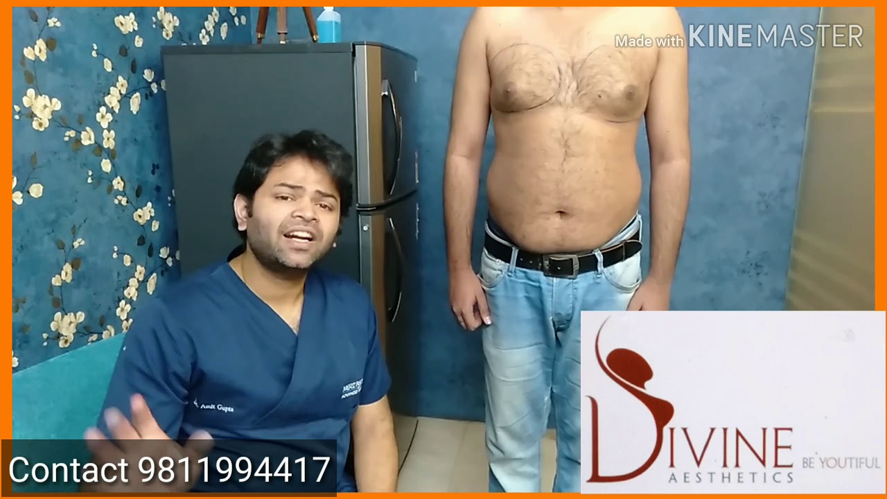 Gynecomastia grade 2 Procedure - YouTube