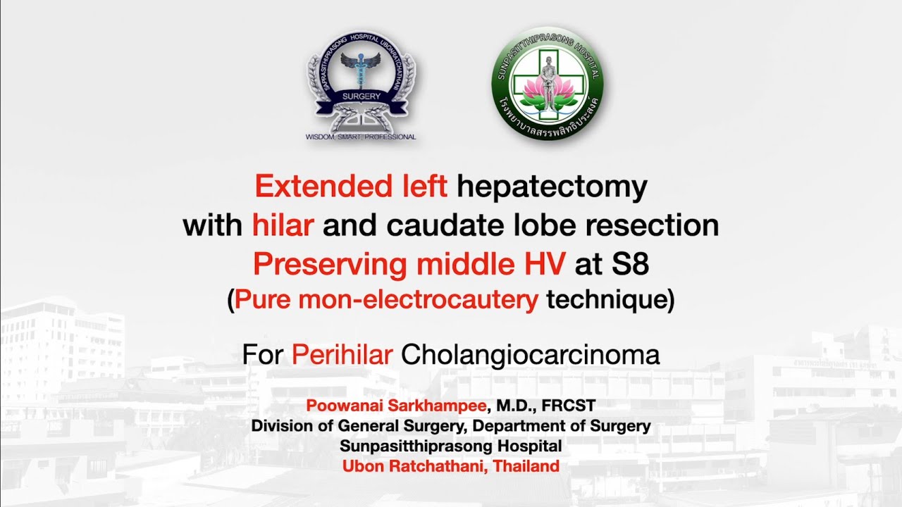 Extended Left Hepatectomy with Hilar Resection and Preserve MHV at S8 ...