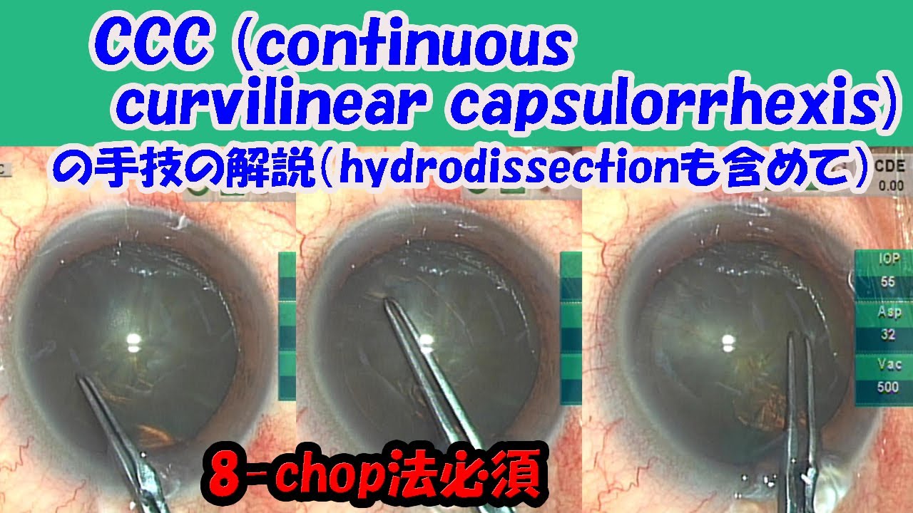 CCC (continuous curvilinear capsulorrhexis）のビデオ解説 - YouTube