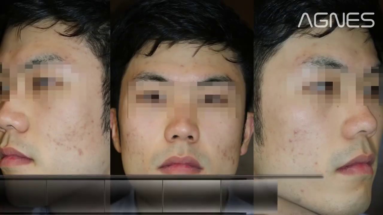 AGNES; Ultimate Solution for Acne - YouTube