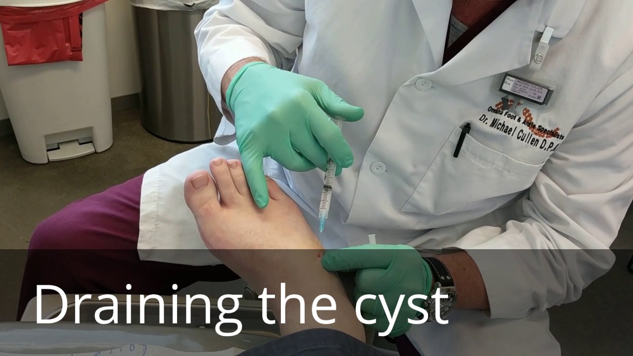 Draining my ganglion cyst - YouTube