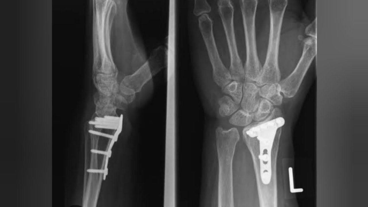 FRACTURA DE RADIO Y CUBITO HACE 2 MESES ME PUSIERON PLACAS PERO LA MANO ...